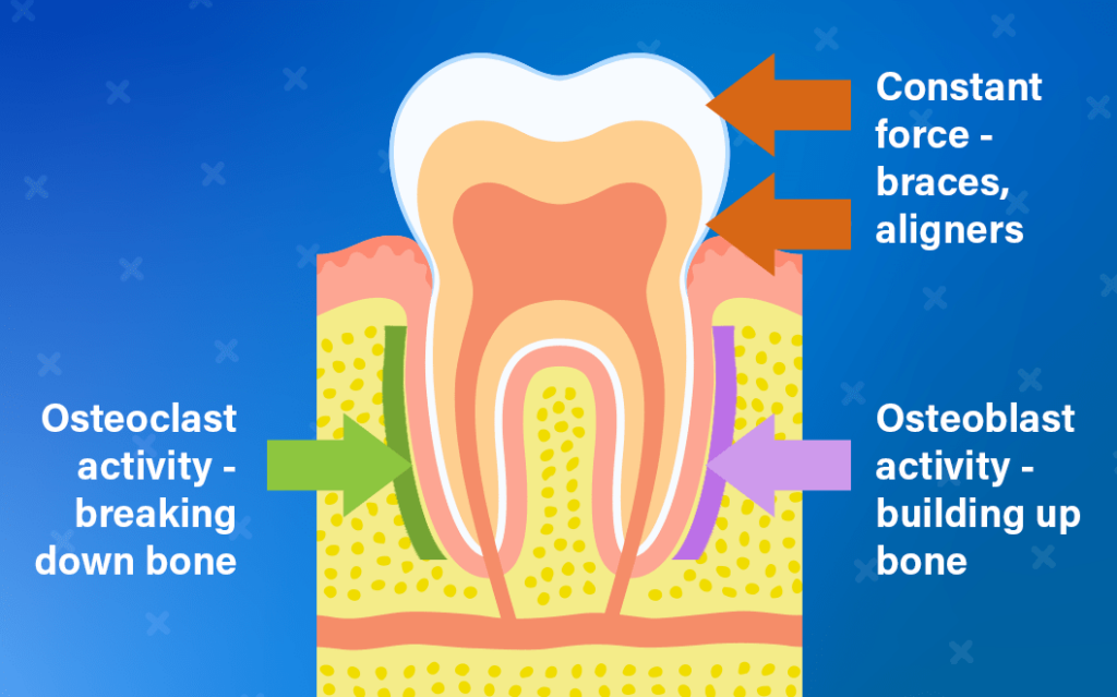 MOPs and Orthodontic Tooth Movement | Propel Orthodontics