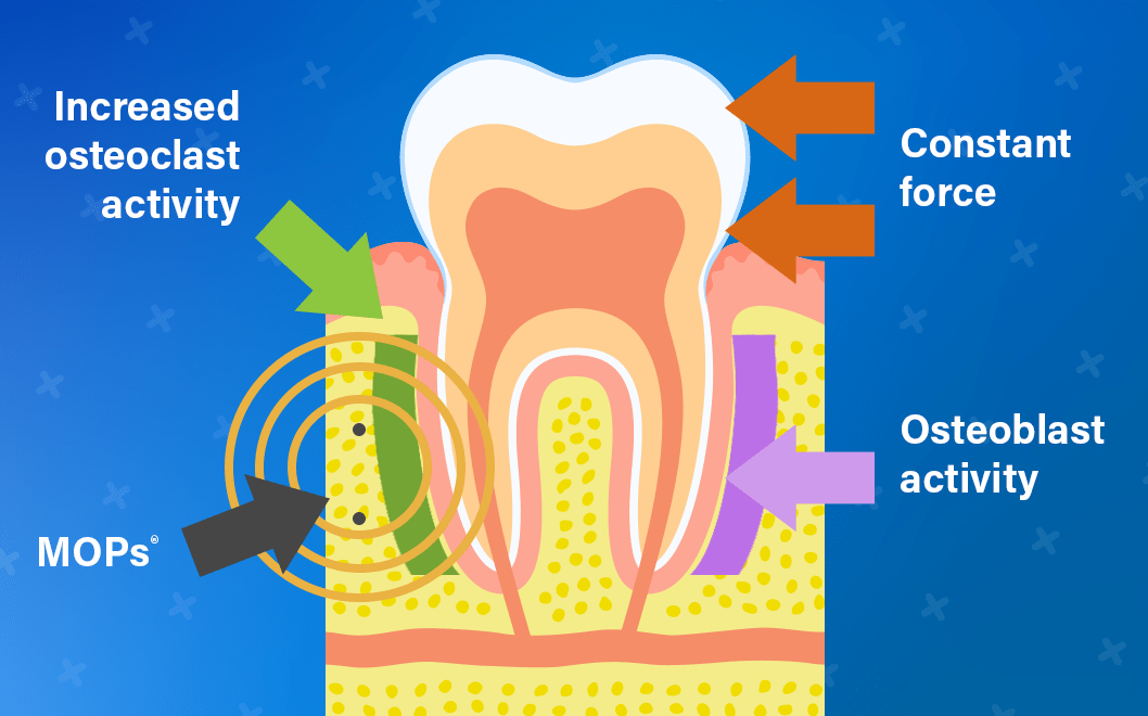 MOPs and Orthodontic Tooth Movement | Propel Orthodontics