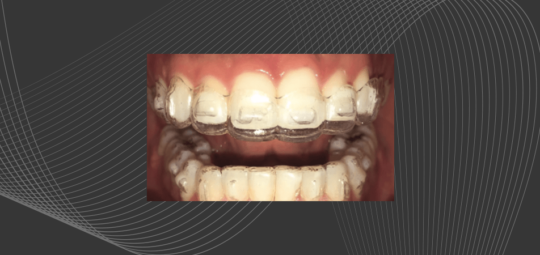 How to Keep Your Aligners Tracking in 5 Minutes |VPro Series