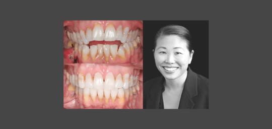 Dr. Bella Shen Garnett Open Bite Case Feature | Propel Ortho