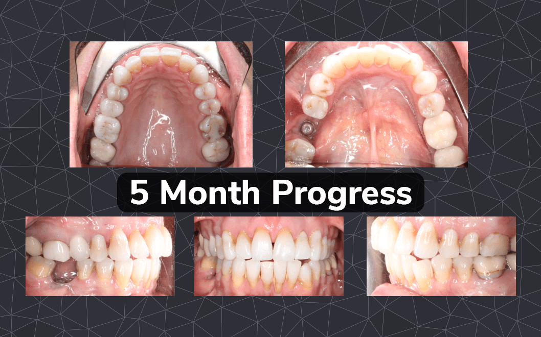 Dr. Bella Shen Garnett Open Bite Case Feature | Propel Ortho