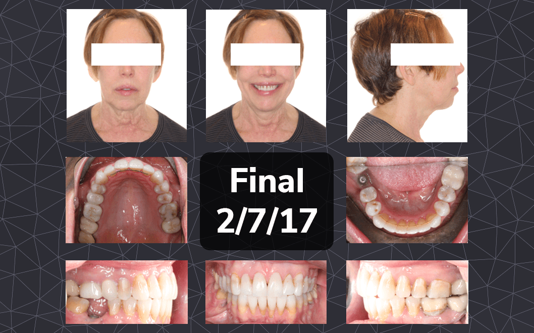 Dr. Bella Shen Garnett Open Bite Case Feature | Propel Ortho