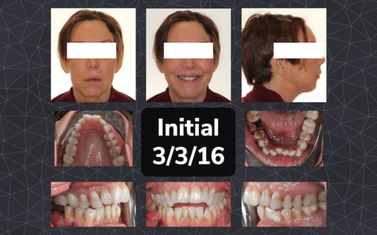 Dr. Bella Shen Garnett Open Bite Case Feature | Propel Ortho